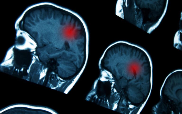 The Long-Term Effects of Frontal Lobe Brain Injuries - Phillips Law Offices