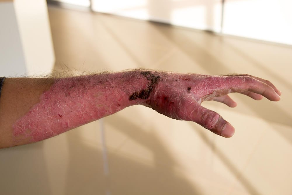 Burn Injury Accidents: Who’s Liable and How to Pursue Compensation ...